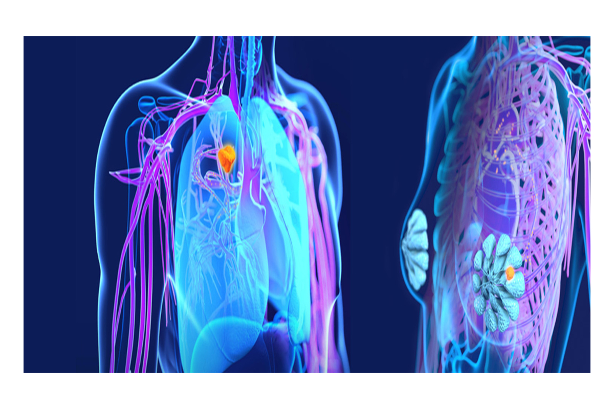 Angle PLC ( AIM:AGL OTCQX:ANPCY) Breakthrough clinical results - Share Talk